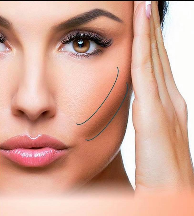 Preenchimento de Malar